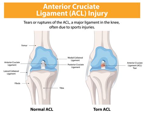 How Long Does An Acl Tear Take To Heal Without Surgery