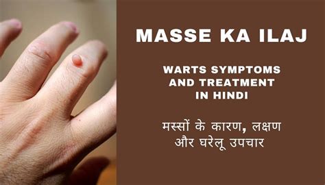 Masse Ka Ilaj Warts Symptoms And Treatment In Hindi