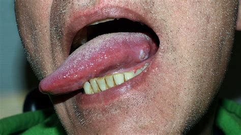 Squamous Cell Carcinoma Tongue How To Check Yourself For Mouth Cancer