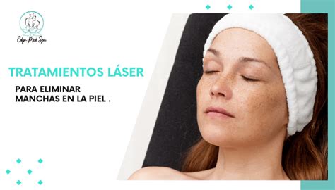 Tratamientos Láser Para Eliminar Manchas En La Piel Edyn Med Spa