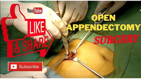 Open Appendectomy Surgery Under Sa Medical Education 👨🏻‍⚕️ Youtube