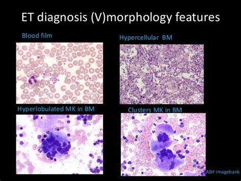 Diagnosis And Management Of Myeloproliferative Neoplasms