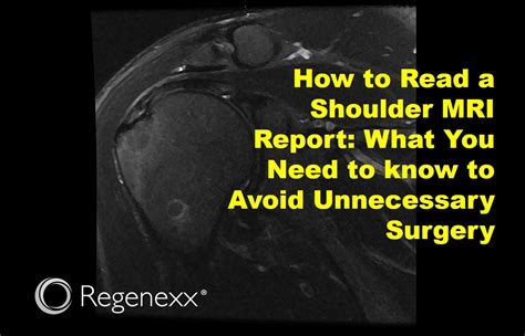 Glenohumeral Ligament Mri