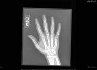 Bone Fracture Object Detection Dataset V Release By Roboflow