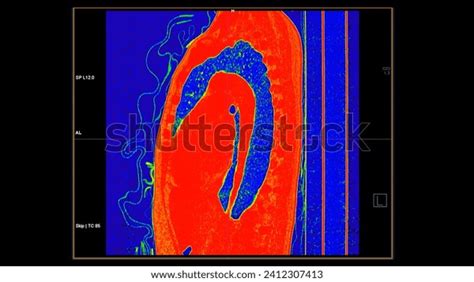 Ct Scan Chest Sagittal View Color Stock Illustration 2412307413