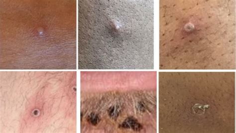 Bne Intellinews Philippines Reports First Mpox Case Since Who