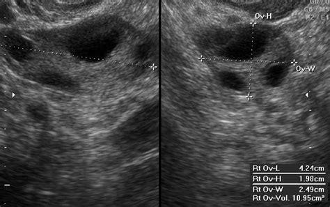 Figure From Updated Ultrasound Criteria For Polycystic 55 Off