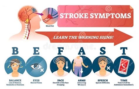 Infographic Depicting Stroke Symptoms Using The Acronym Befast Stock