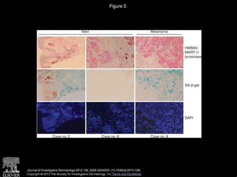 Absence Of Distinguishing Senescence Traits In Human Melanocytic Nevi