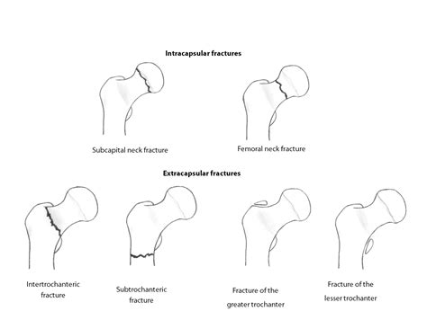 Classification Of Hip Fracture At Bennie Morris Blog