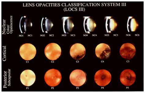 Towards A Connected Mobile Cataract Screening System A Future Approach