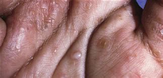 Acropustulosis Of Infancy