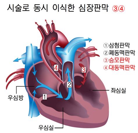 고장난 심장 승모·대동맥판막 동시 시술 국내 첫 성공