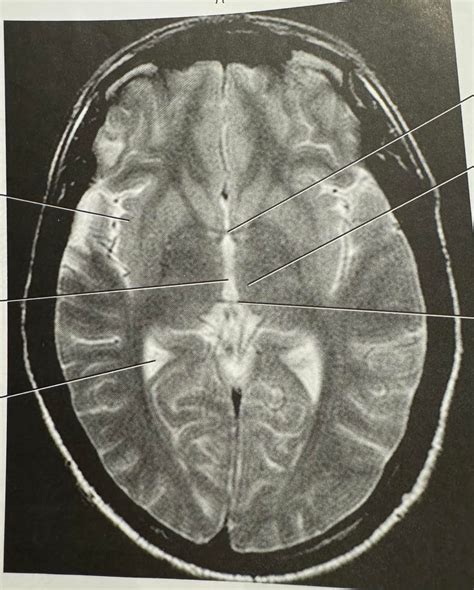 Study Guide Unit 6 Cerebrum And Diencephalon 5 Diagram Quizlet