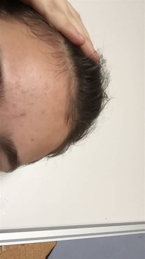 Bumps On My Forehead General Acne Discussion Forum