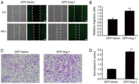 Human Giant Larvae1 Promotes Migration And Invasion Of Malignant