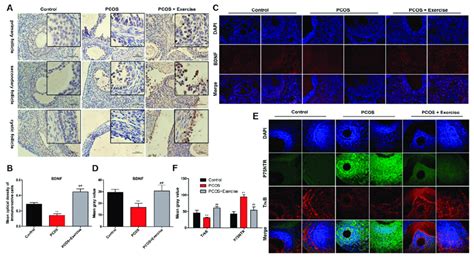 The Expression Of Bdnf Trkb And P75ntr In Ovarian Follicles Of Pcos