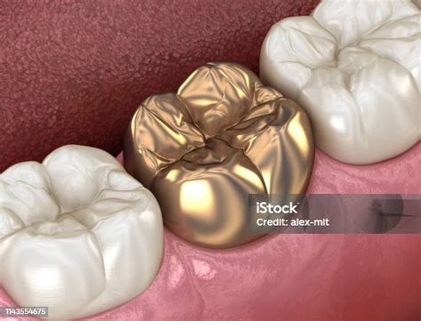 골든 크라운 몰 이빨 조립 공정 인간의 치아 치료의 의학적으로 정확한 3d 그림 0명에 대한 스톡 사진 및 기타 이미지 0명 건강관리와 의술 금속 Istock