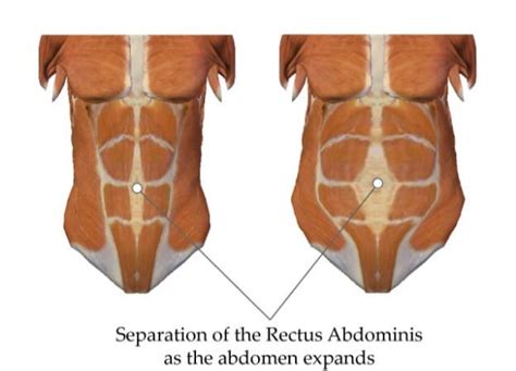 Understanding Diastasis Recti Vs Pooch Belly In Eds Causes And How To