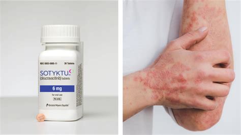 Sotyktu Deucravacitinib Gets Fda Approval For Moderate To Severe