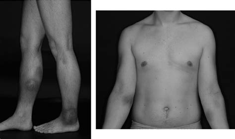 Views Of Upper And Lower Limbs Showing Hyperpigmented Macules