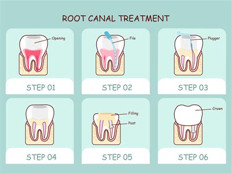 What You Need To Know About Root Canal Treatment