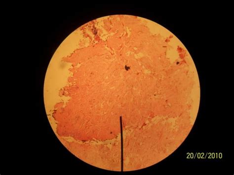 Diseases Of Breast Pptx