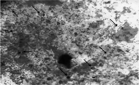 Modified Acid Fast Stained Slide From Suspected Sample Showing