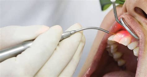 Gingivectomy Procedure Steps