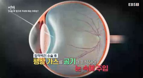 Ebs명의 망막박리 1편ㅣ열공망막박리ㅣ공막돌륨술ㅣ이성진 네이버 블로그