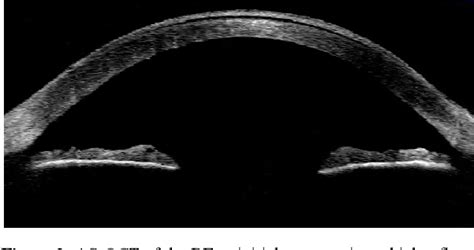Figure 2 From Treatment Of Interface Fluid Syndrome After Laser Assisted In Situ Keratomileusis