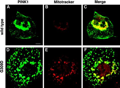 Hereditary Early Onset Parkinsons Disease Caused By Mutations In Pink1