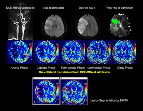 The Collateral Map Prediction Of Lesion Growth And Penumbra After Acute Anterior Circulation