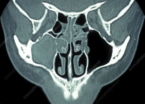 Infected Maxillary Sinus Ct Scan Stock Image M260 0404 Science
