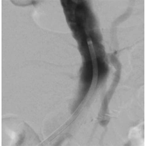 Completion Angiogram Demonstrating A Patent Inferior Mesenteric Artery