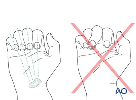 K Wire Fixation For Dislocation And Fracture Dislocation Of The