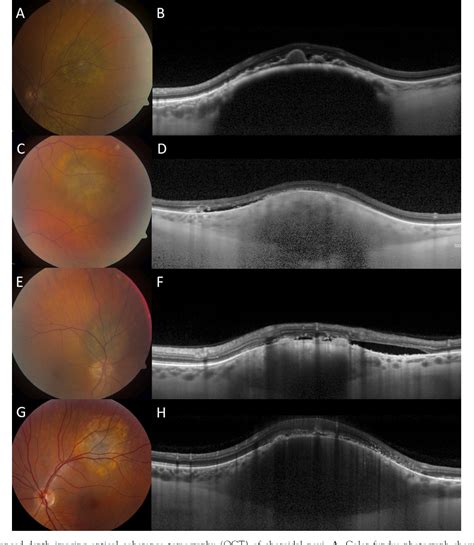 Choroidal Nevus