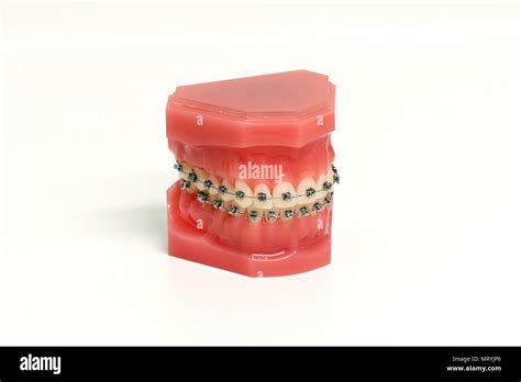 Orthodontic Mold Of A Dental Appliance Showing A Set Of Upper And Lower