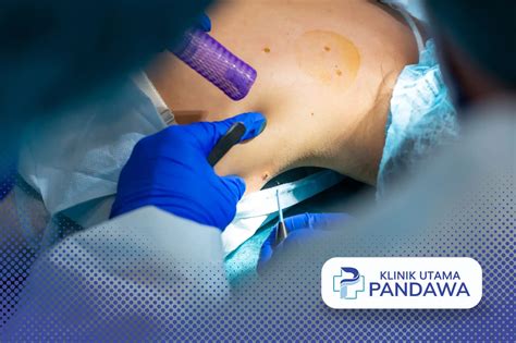 7 Cara Menghilangkan Tompel Dengan Aman Dan Efektif Untuk Kulit Cerah