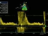 Reverse Diastolic Flow Descending Aorta Video MEDtube Net