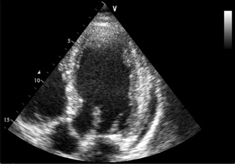 Cardiac Echo In 03 2018 With Echo Rich Myocardium And Dilated Left Download Scientific Diagram