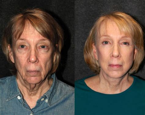 Deep Plane Facelift Before After Dr Andrew Jacono Face Lift Surgery Facial Rejuvenation