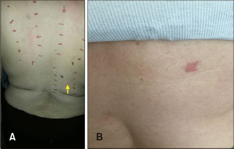 A Positive Patch Test Reaction To Bacitracin At 48 Hours Yellow Download Scientific Diagram