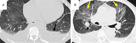 Pulmonary Invasive Fungal Disease And Bacterial Pneumonia A
