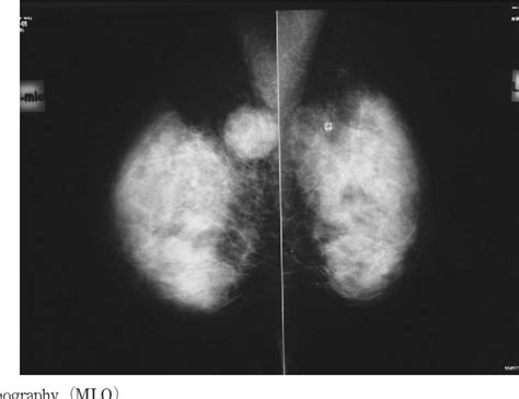 Figure 1 From A Case Of Primary Malignant Lymphoma Of The Breast With