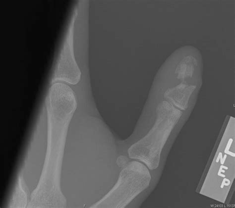 Thumb X Rays Of Rays Thumb November 2006