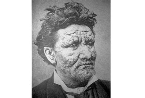 Leprosy Slideshow