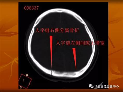 颅骨内外板皮质第6页大山谷图库