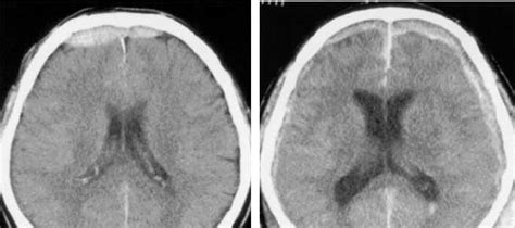 Acute Epidural Hematoma Axial Non Enhanced Ct Shows A Well Localized