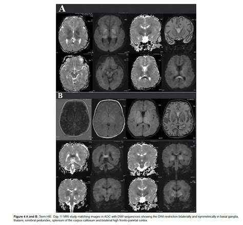 Journal Of Radiology Hypoxic Ischemic Encephalopathy Mri Findings And